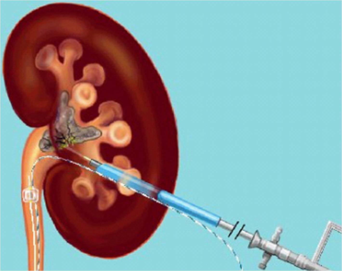 The Risks and Complications of PCNL Procedure for Kidney Stones ...